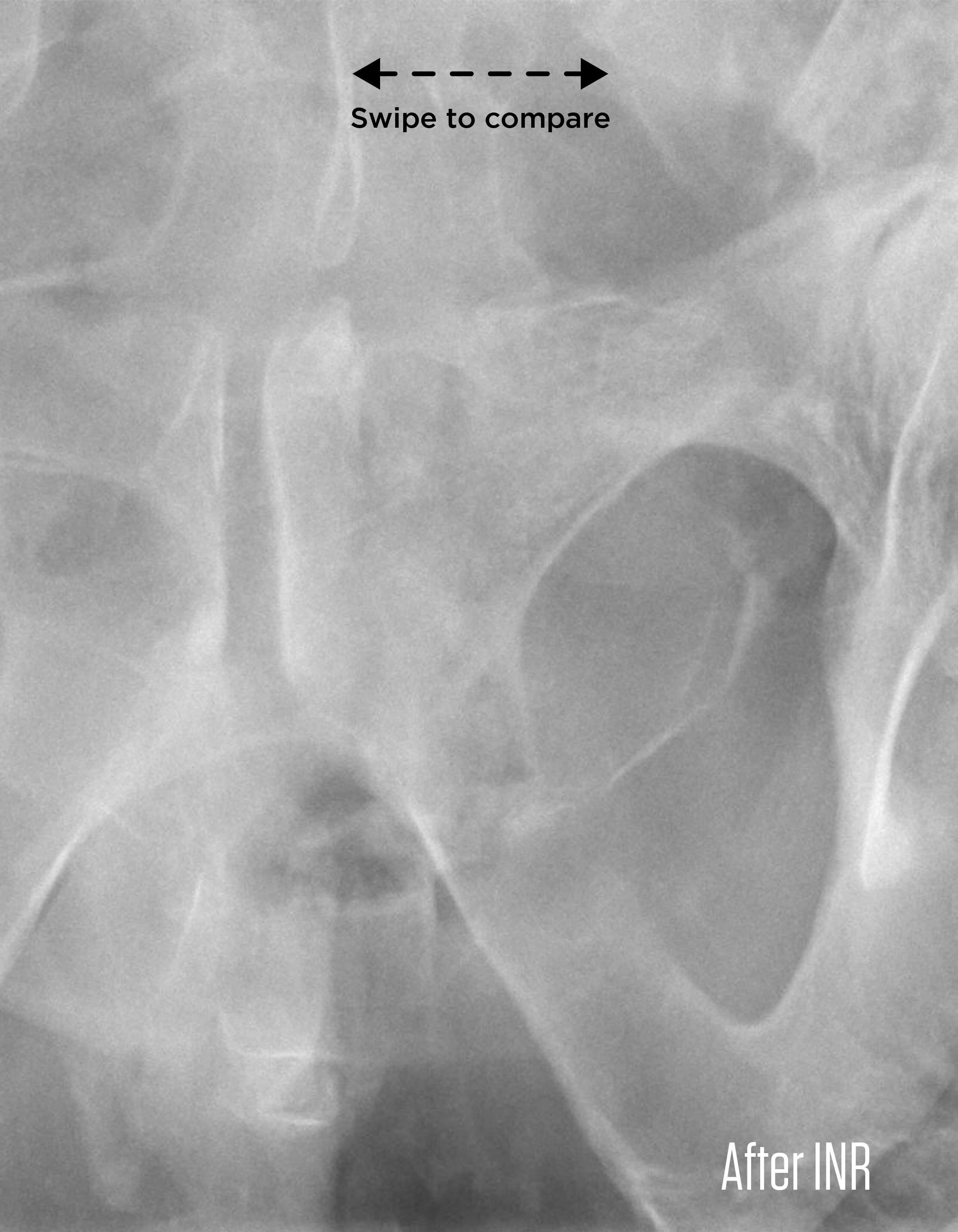 Canon intelligent-noise-reduction - Canon Medical Components Europe